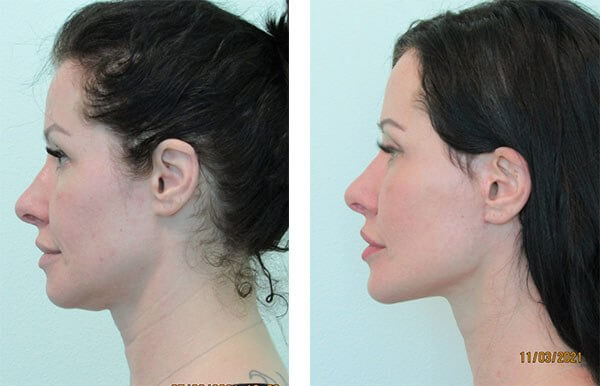 How Much is Chin Augmentation? | The Lafranchi Center